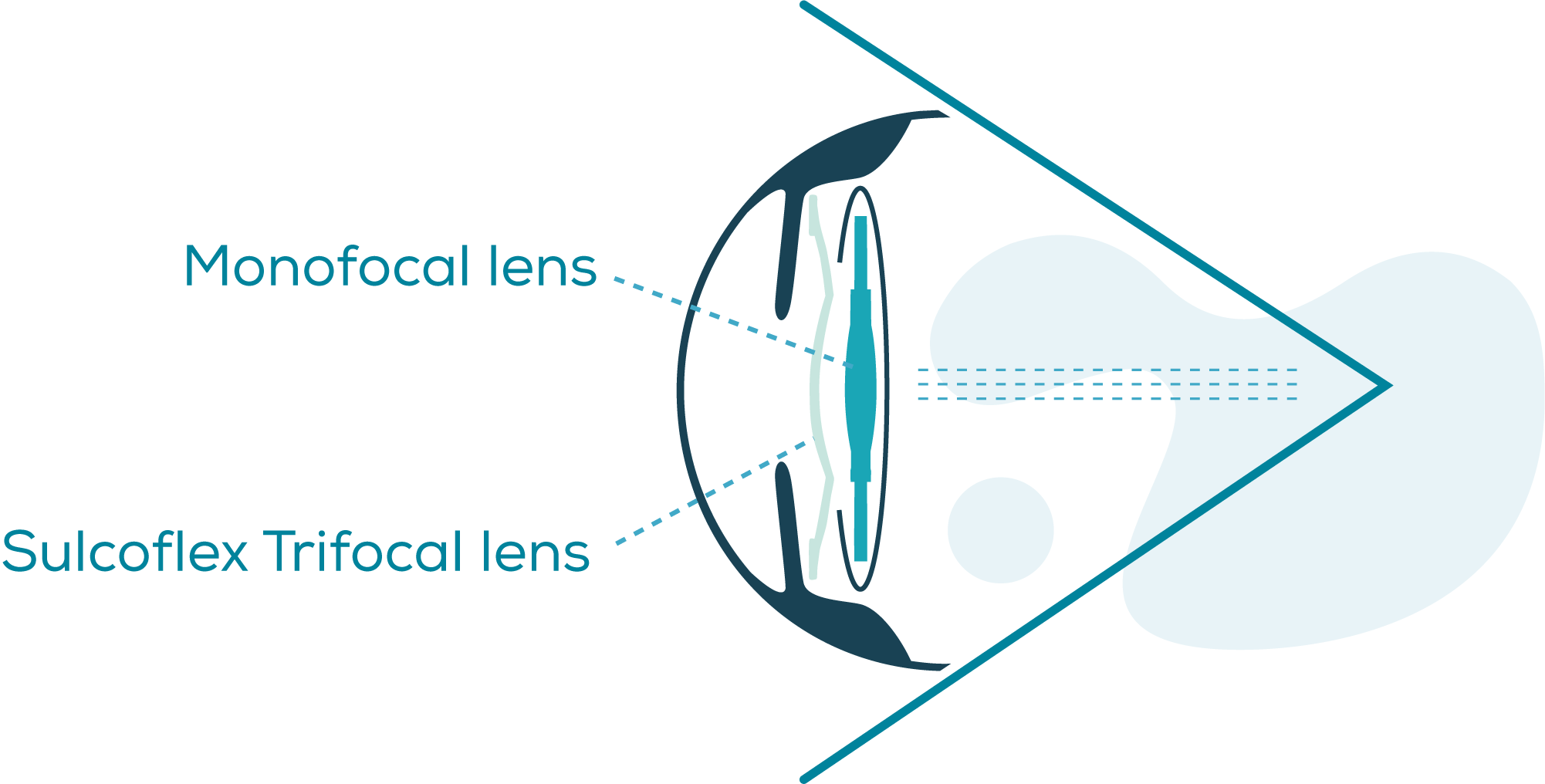 Sulcoflex Trifocal DUET procedure | Rayner