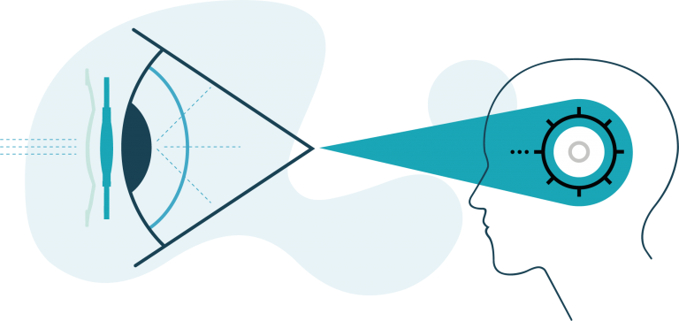 Sulcoflex Trifocal DUET procedure | Rayner
